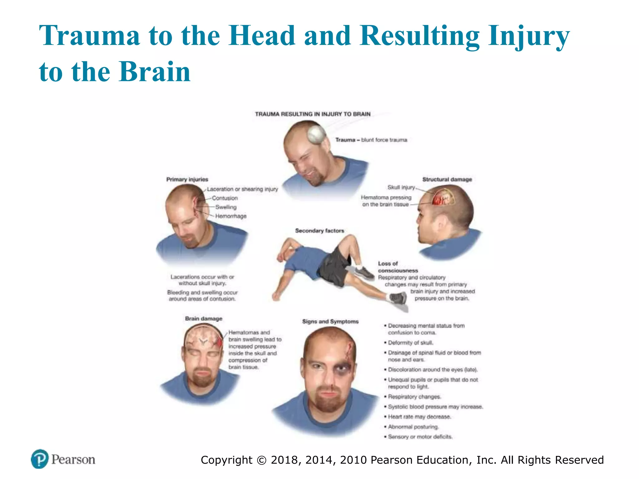 Pec11 chap 31 head trauma | PPTX