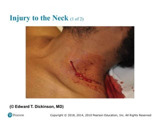 Incised Wound To The Neck