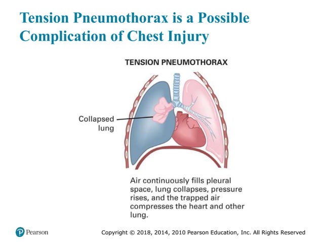 Pec11 chap 34 chest trauma | PPTX | First Aid | Injuries