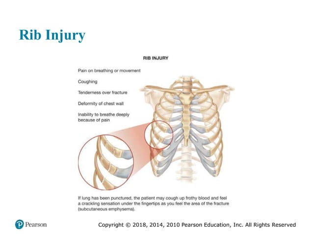 Pec11 chap 34 chest trauma | PPTX | First Aid | Injuries