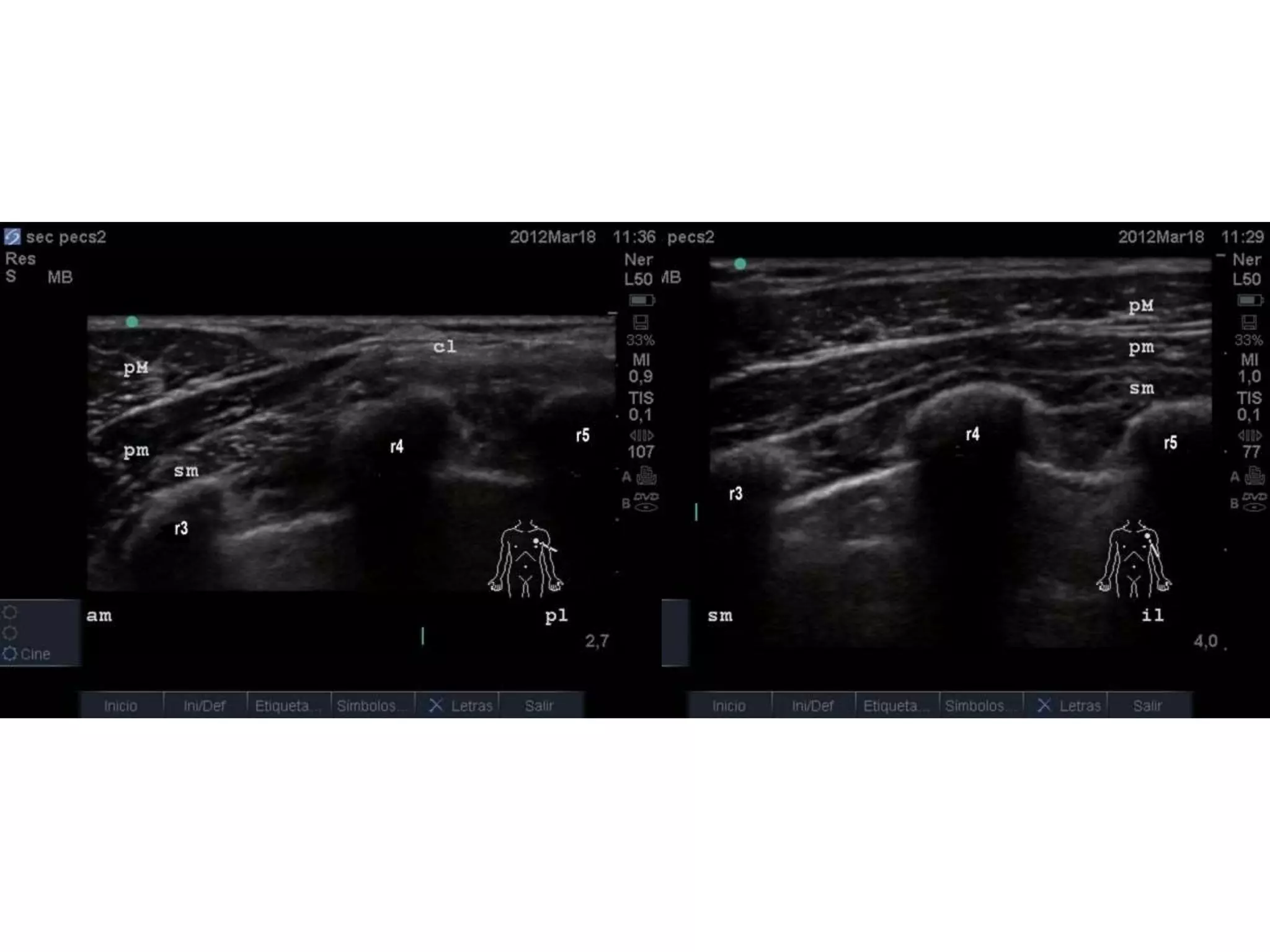 Pec I and PECS II, serratus anterior block | PPTX