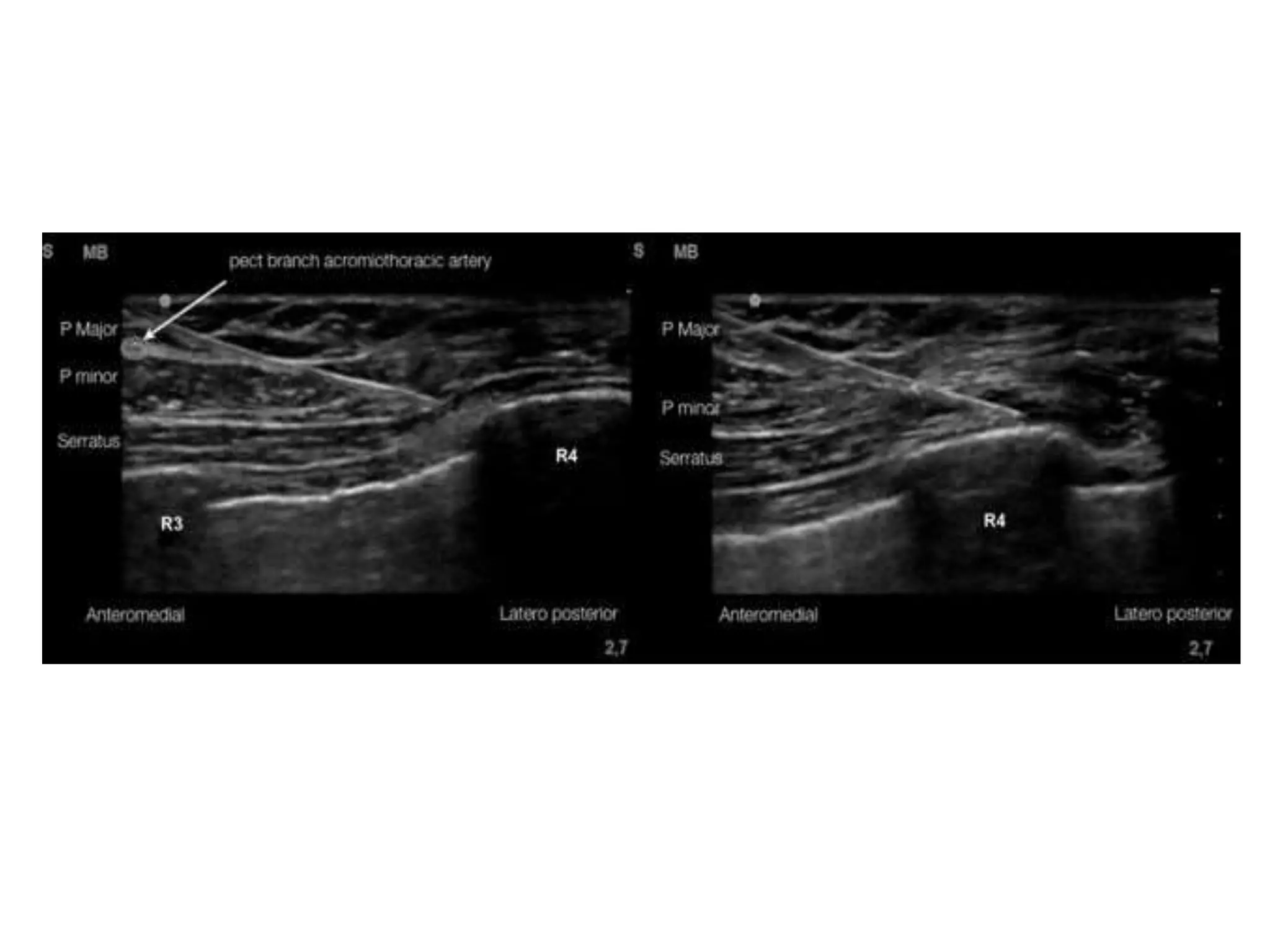 Pec I and PECS II, serratus anterior block | PPTX