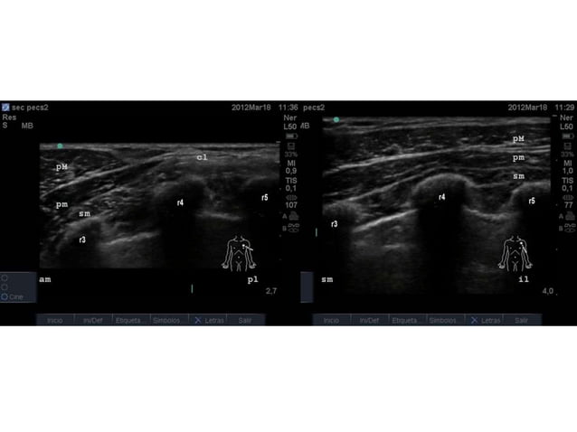 Pec I and PECS II, serratus anterior block | PPTX