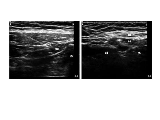 Pec I and PECS II, serratus anterior block | PPTX