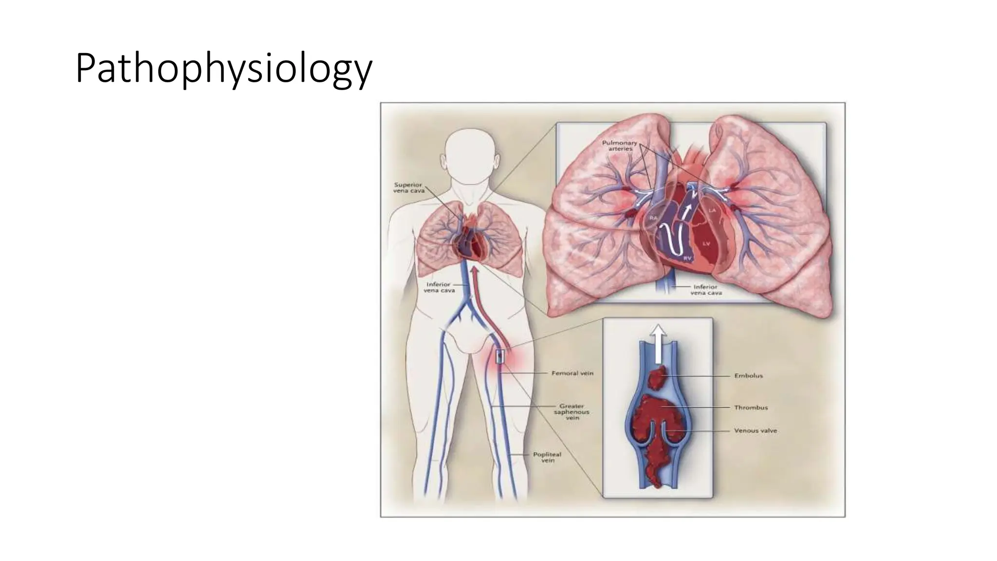 Pulmonary Embolism for Nurses.pptx