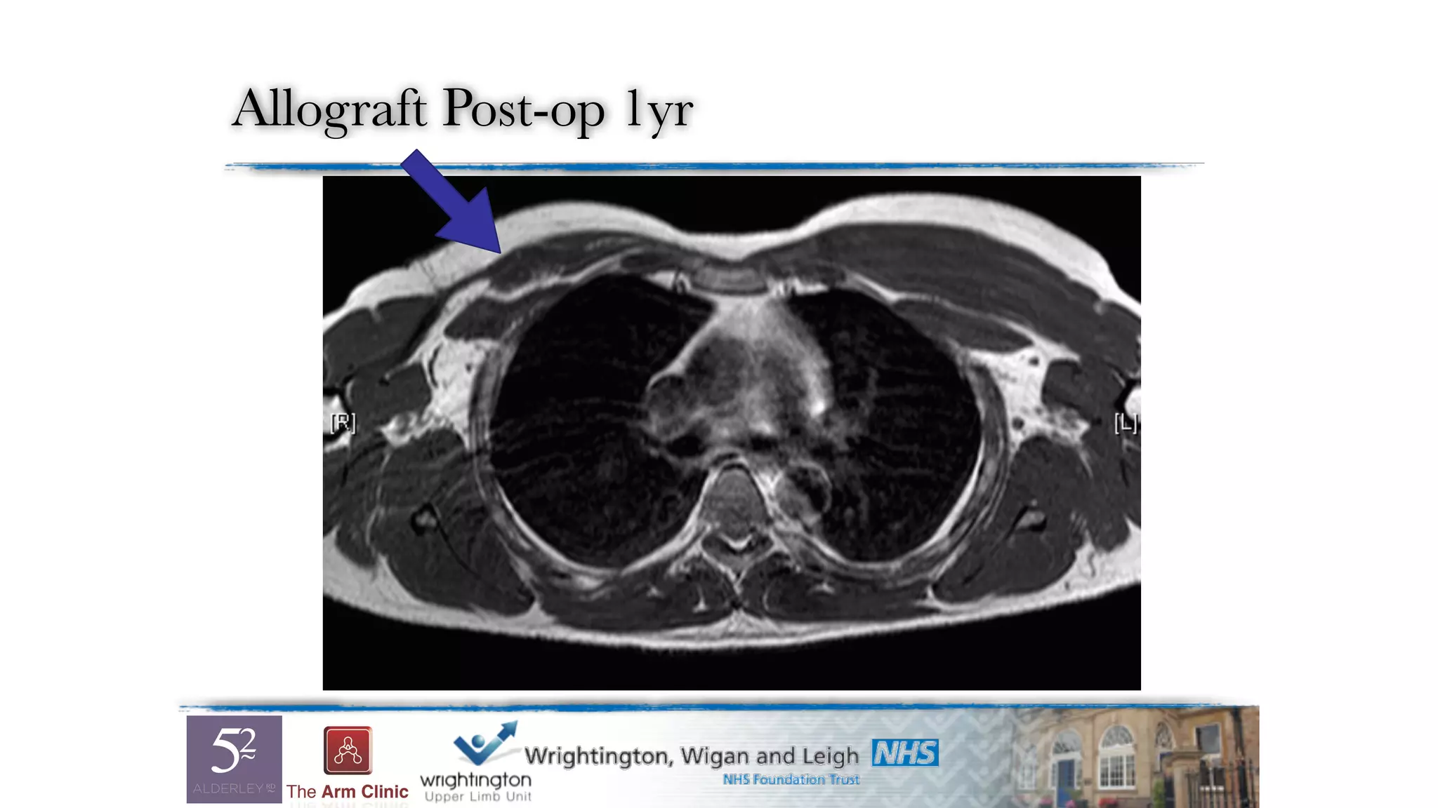 Pectoralis Major Injuries for BESS 2020 | PDF
