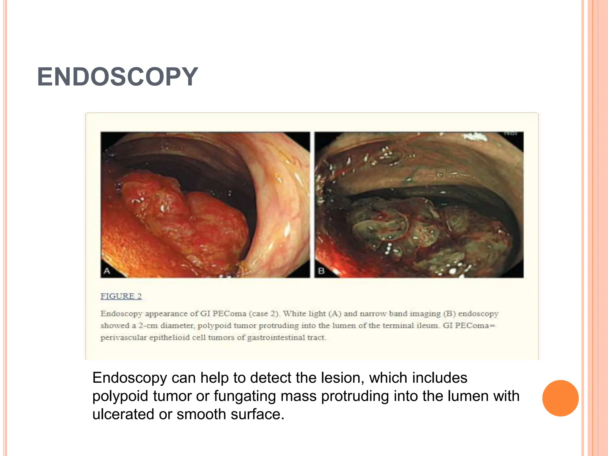 Perivascular Epithelioid Cell Tumors ( PEComa) of GIT | PPTX