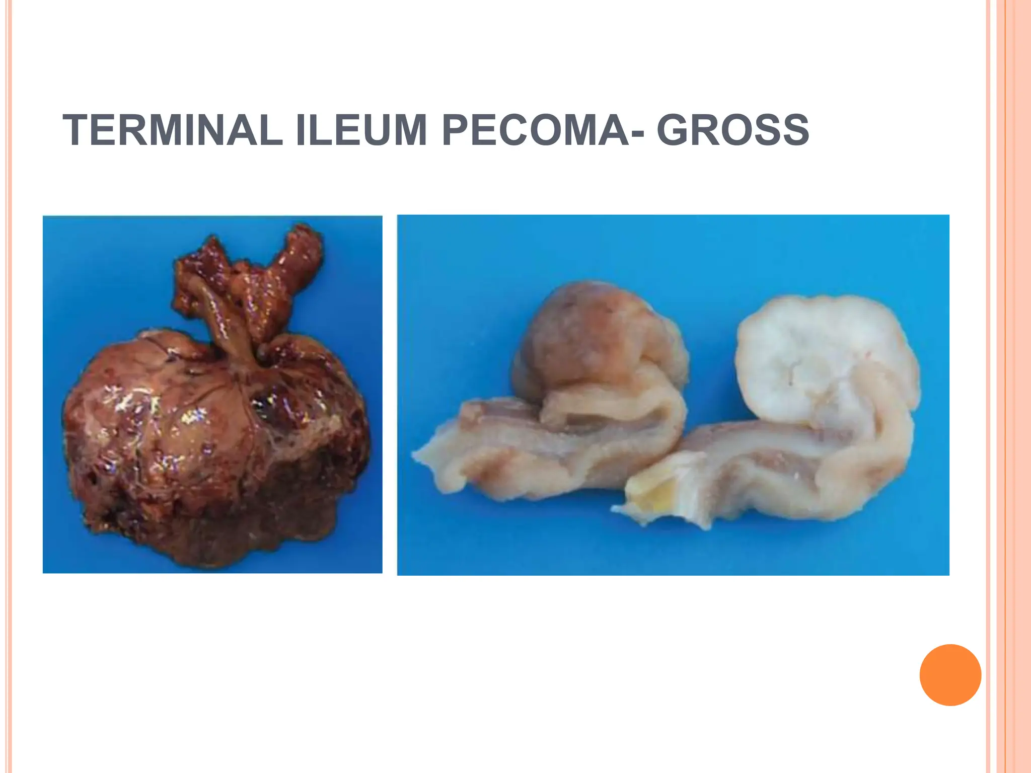 Perivascular Epithelioid Cell Tumors ( PEComa) of GIT | PPTX