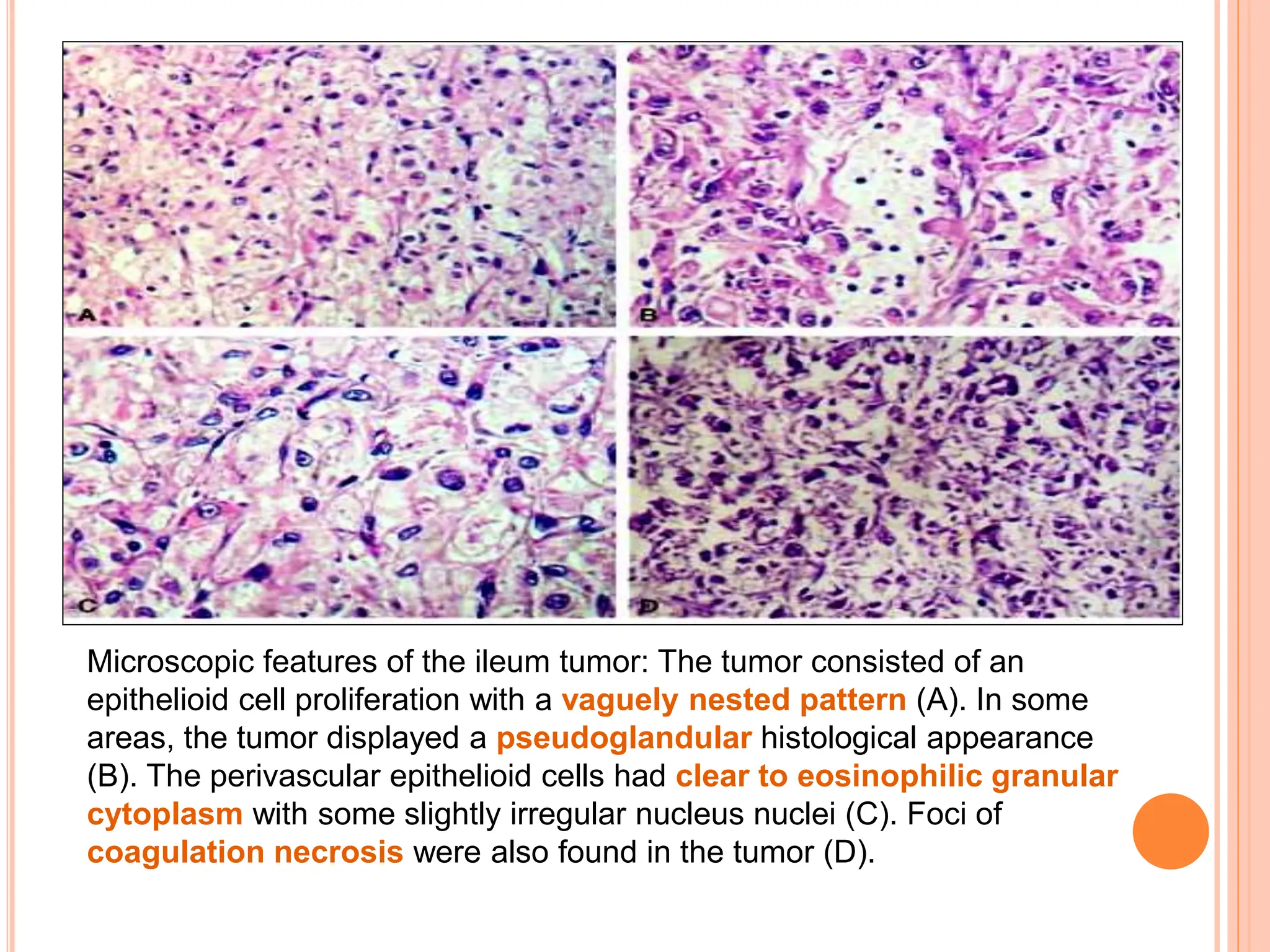 Perivascular Epithelioid Cell Tumors ( PEComa) of GIT | PPTX