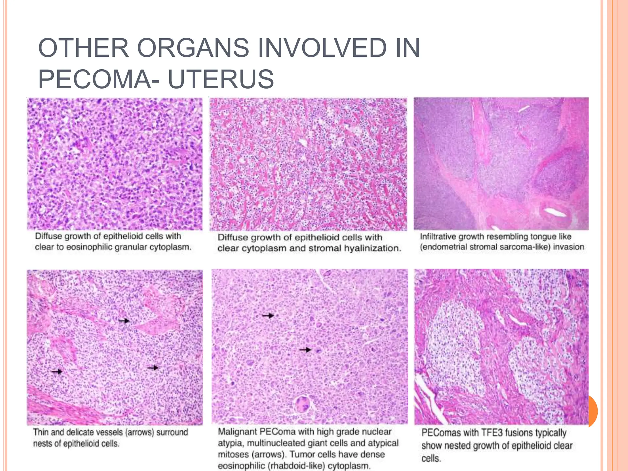 Perivascular Epithelioid Cell Tumors ( PEComa) of GIT | PPT