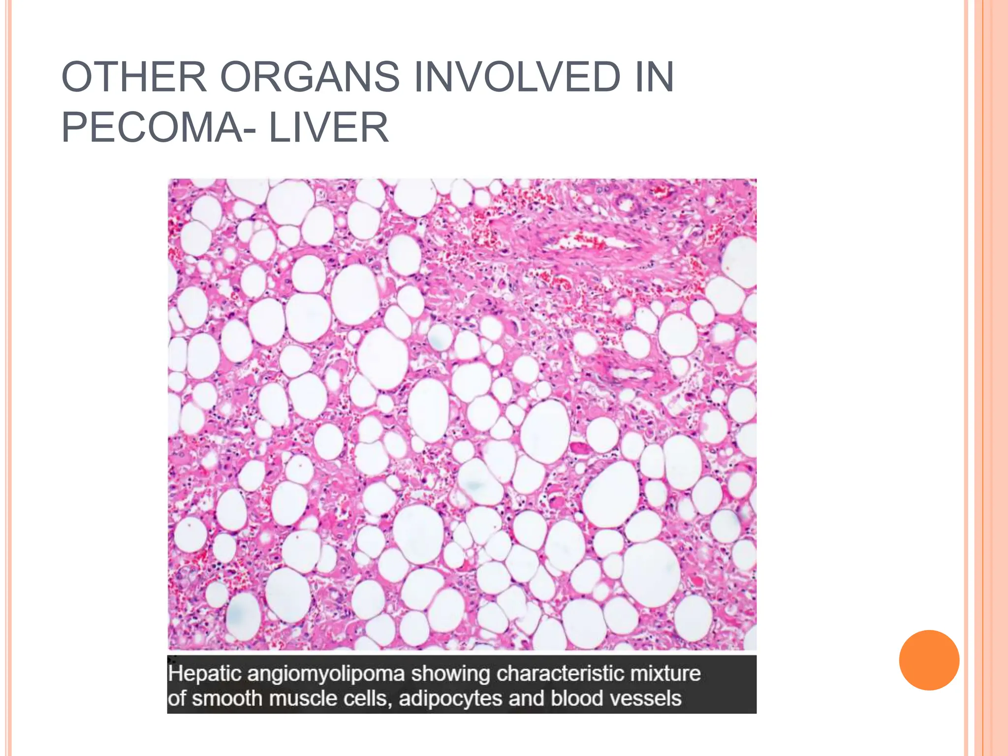 Perivascular Epithelioid Cell Tumors ( PEComa) of GIT | PPT