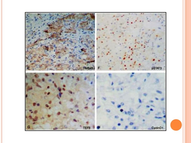 Perivascular Epithelioid Cell Tumors ( PEComa) of GIT | PPT