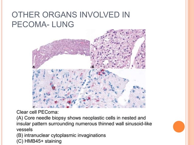 Perivascular Epithelioid Cell Tumors ( PEComa) of GIT | PPT