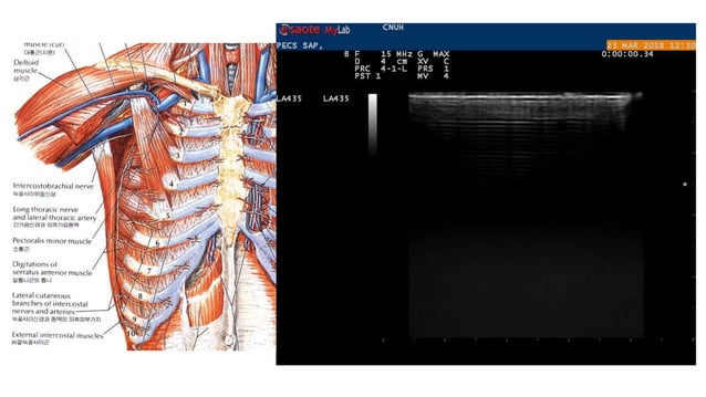 Pecs block, serratus plane block with literature review when and how | PPTX