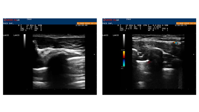 Pecs block, serratus plane block with literature review when and how | PPTX