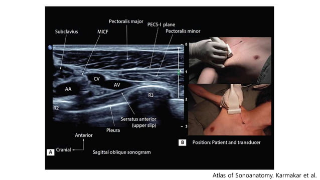 Pecs block, serratus plane block with literature review when and how | PPTX
