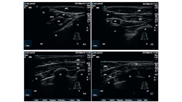 Pecs block, serratus plane block with literature review when and how | PPTX