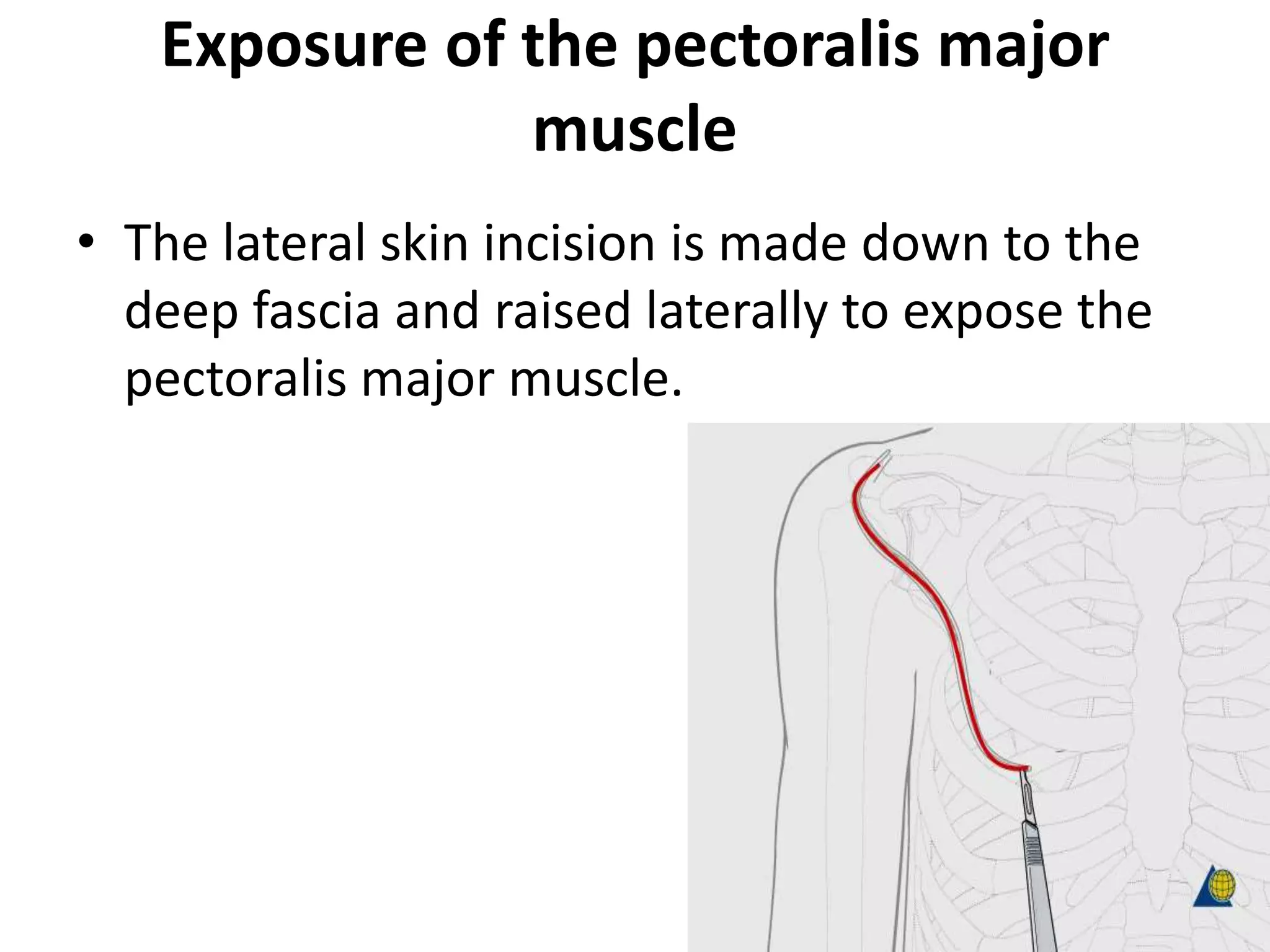 Pectoralis major flap | PPTX