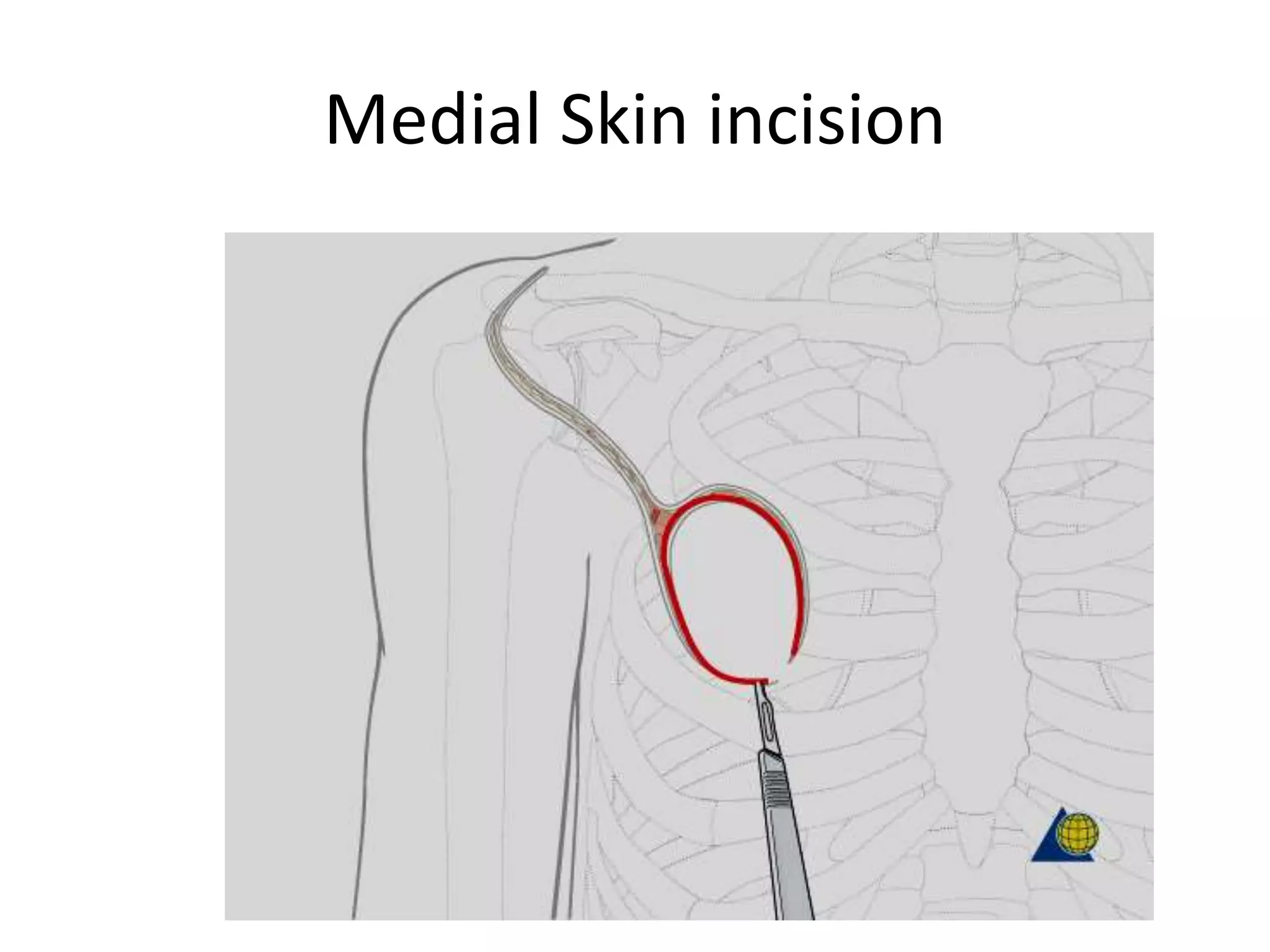 Pectoralis major flap | PPTX