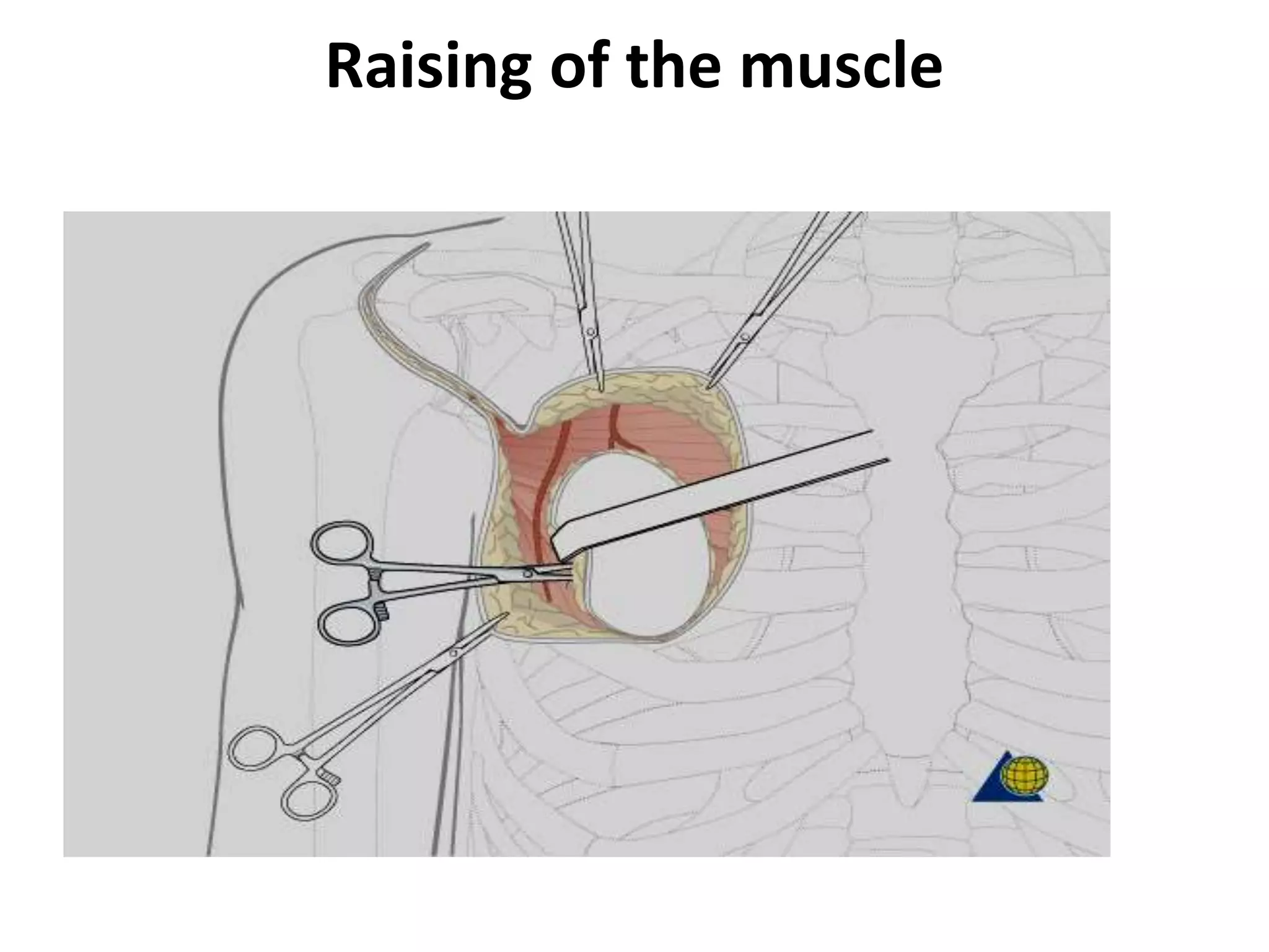 Pectoralis major flap | PPTX