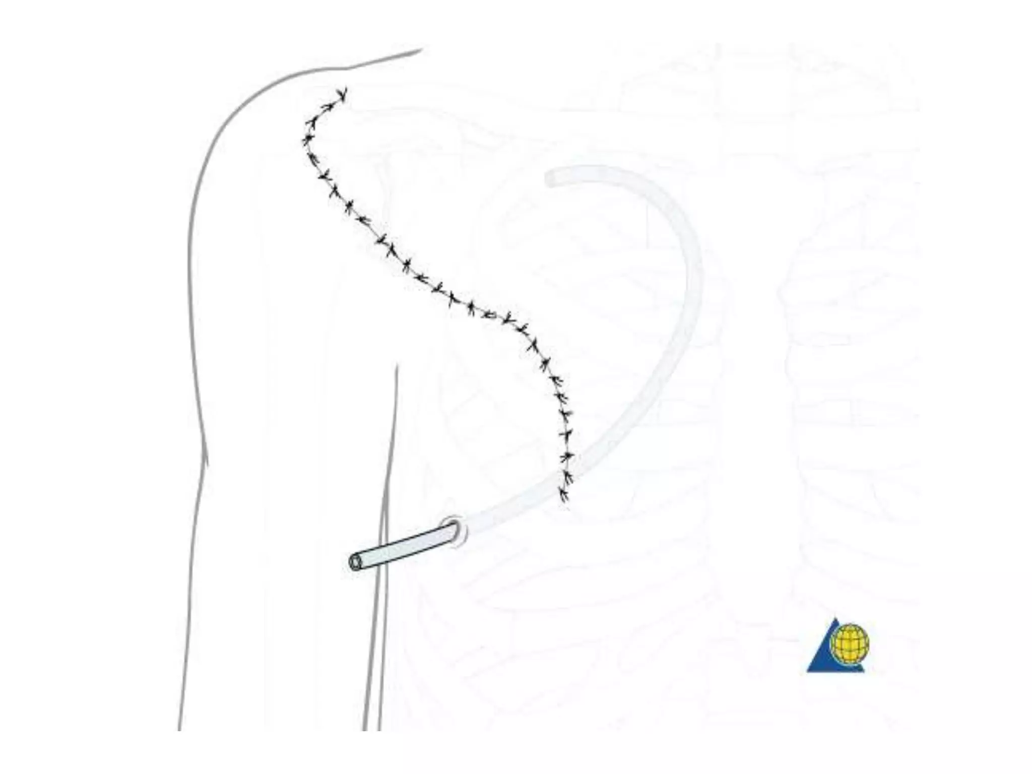 Pectoralis major flap | PPTX