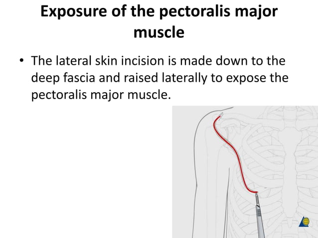 Pectoralis major flap | PPTX
