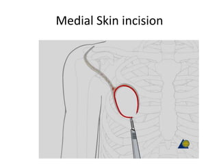 Pectoralis major flap | PPTX
