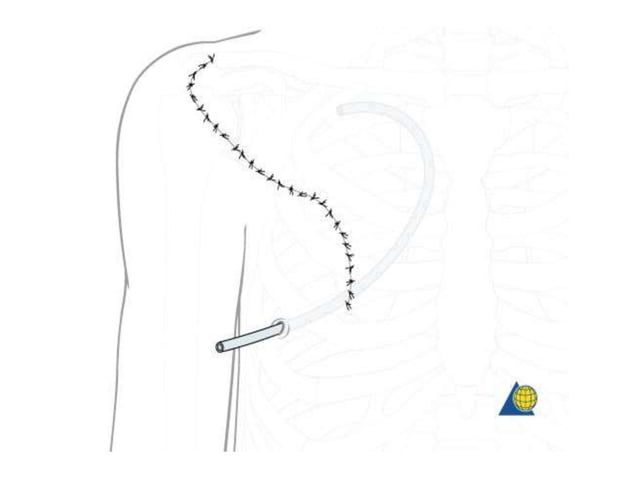 Pectoralis major flap | PPTX