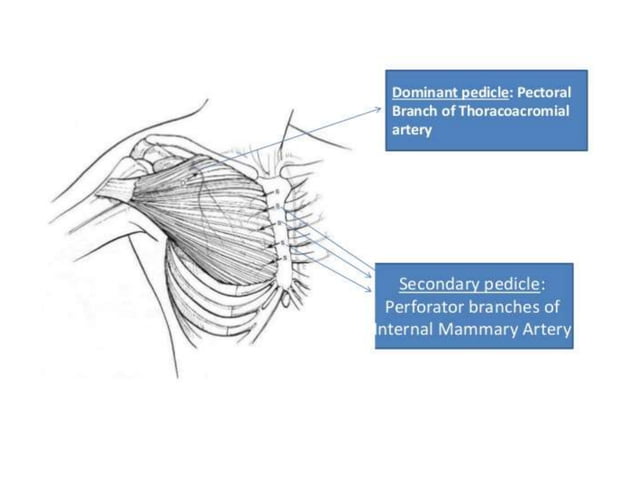 Pectoralis major flap | PPTX