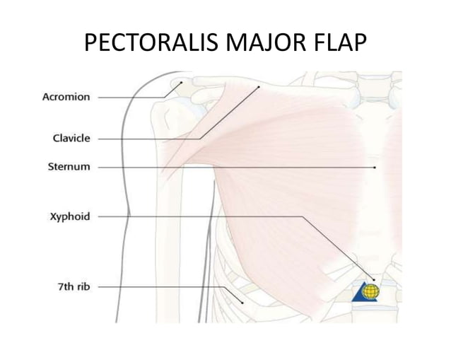 Pectoralis major flap | PPTX