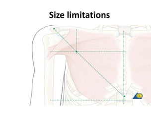 Pectoralis major flap | PPTX