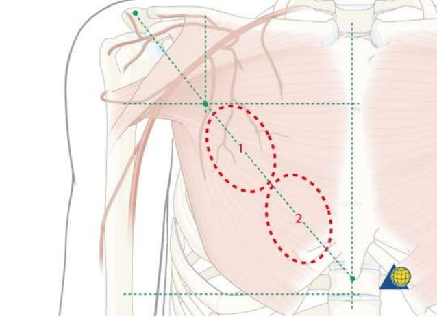 Pectoralis major flap
