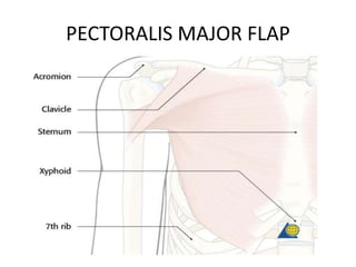 Pectoralis major flap | PPT
