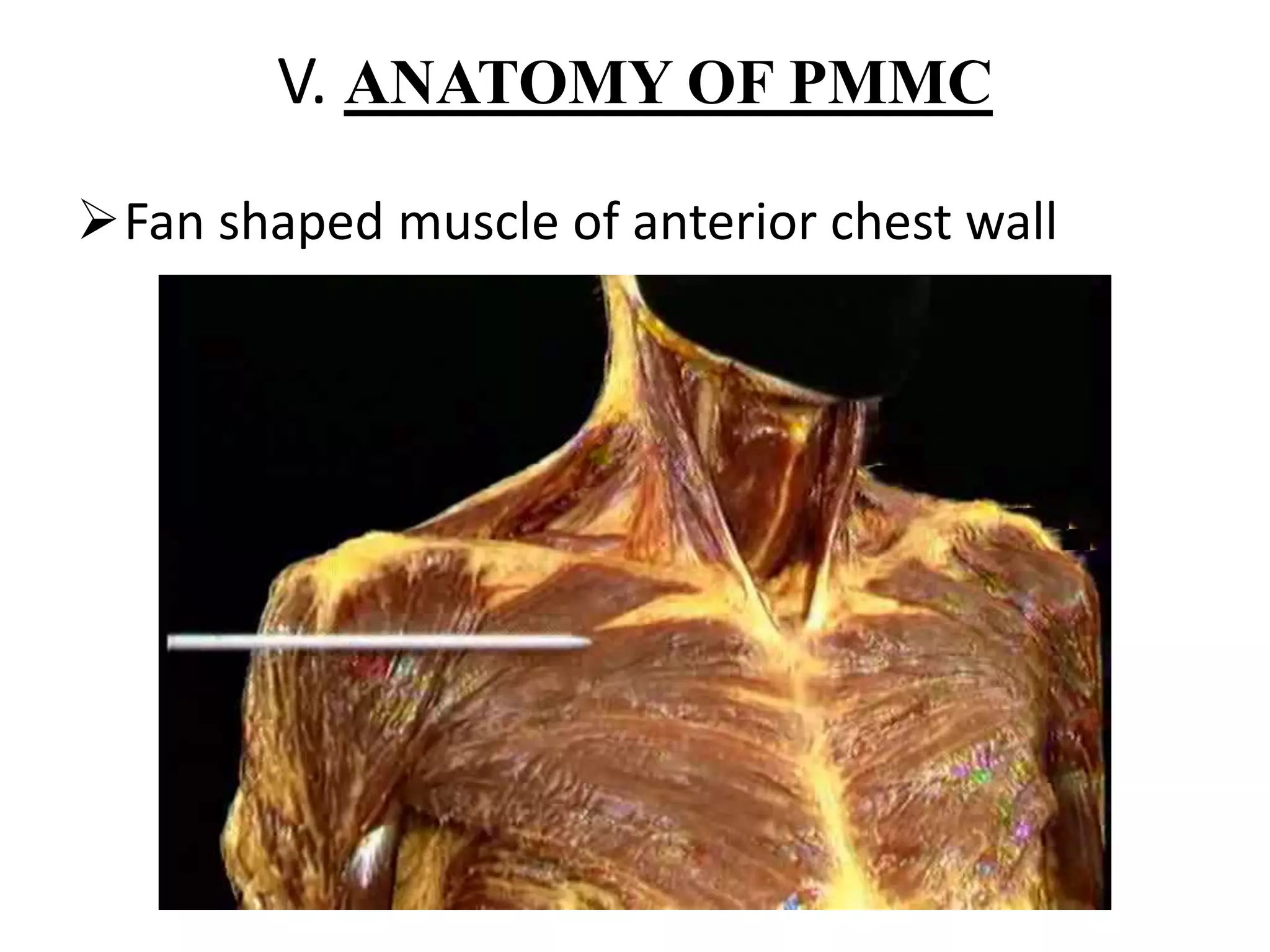 Pectoralis Major Myocutaneous Flap in Head and Neck Reconstruction | PPTX
