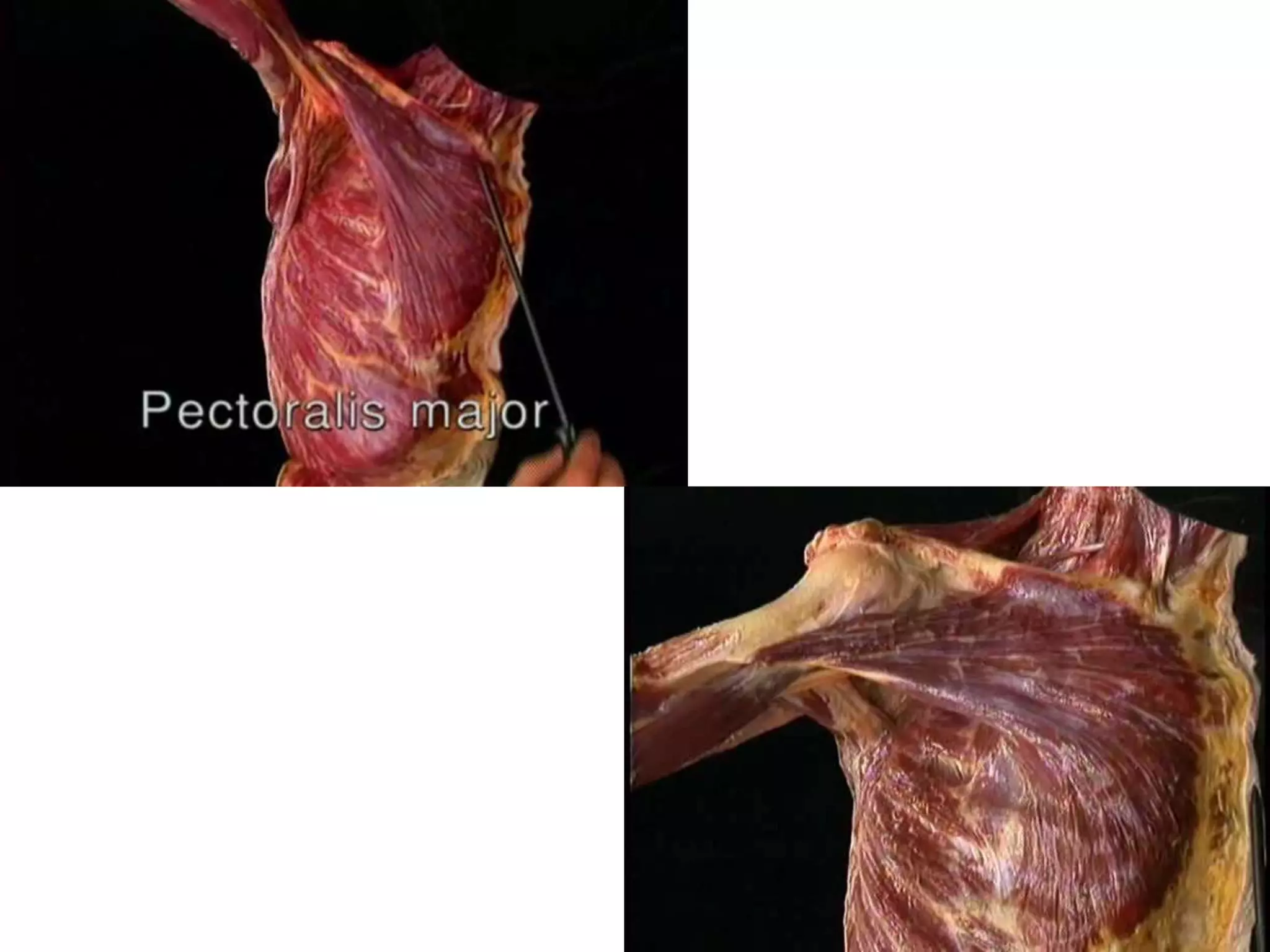 Pectoralis Major Myocutaneous Flap in Head and Neck Reconstruction | PPTX