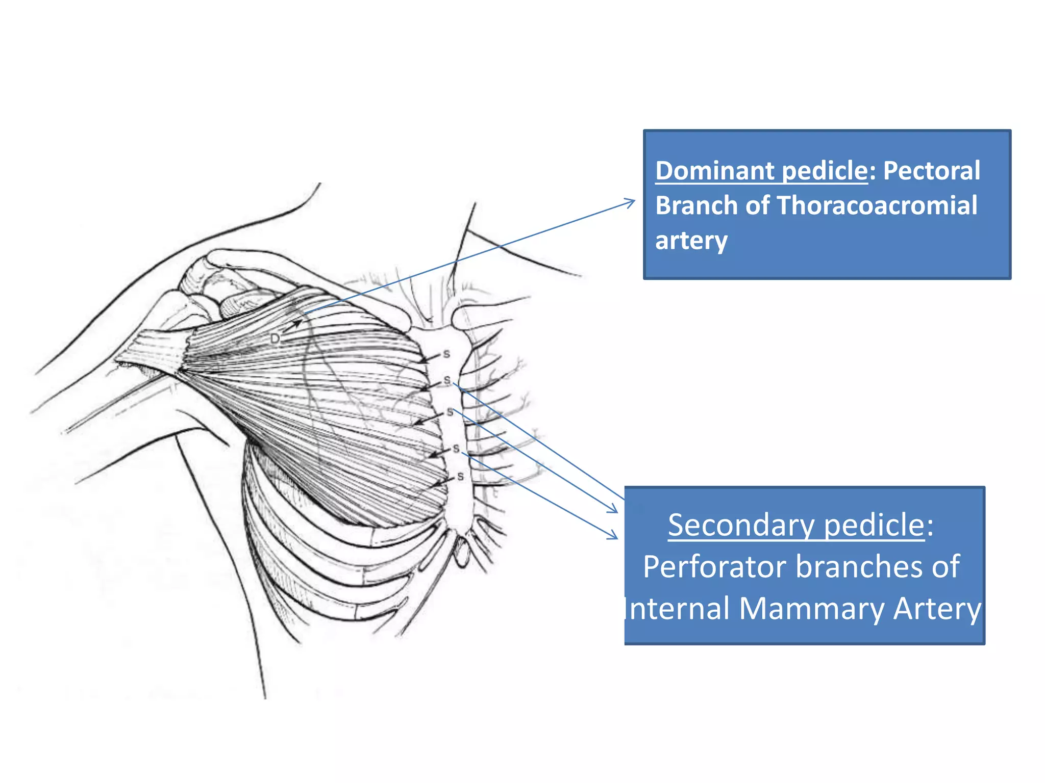 Pectoralis Major Myocutaneous Flap in Head and Neck Reconstruction | PPTX