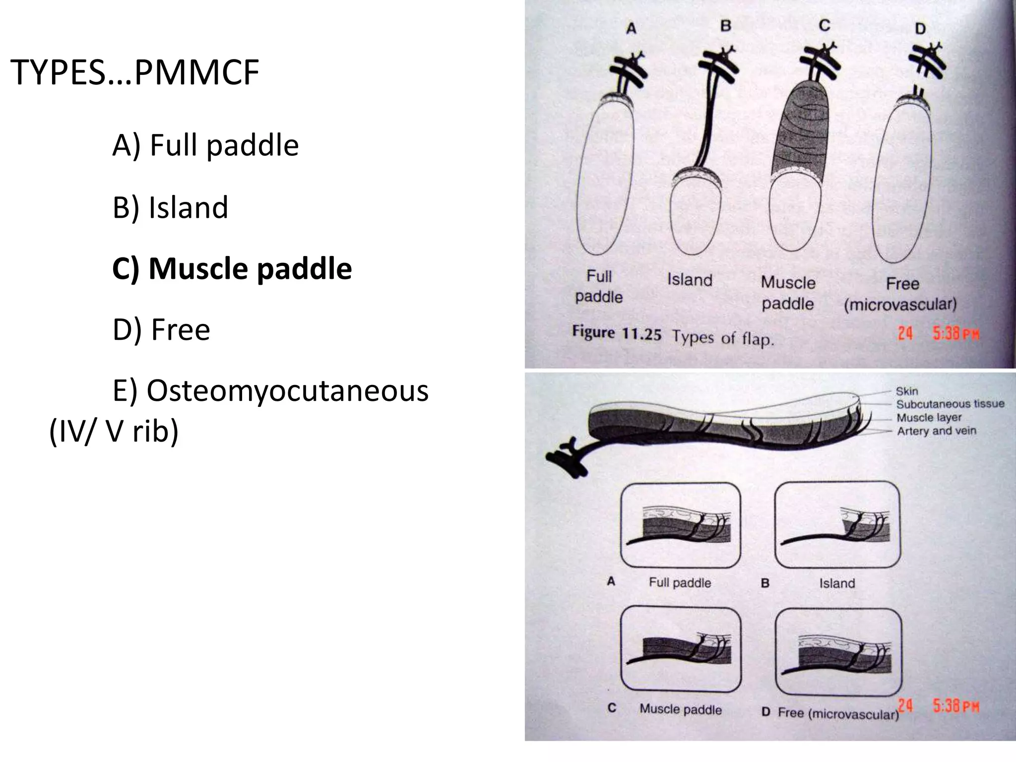 Pectoralis Major Myocutaneous Flap in Head and Neck Reconstruction | PPTX