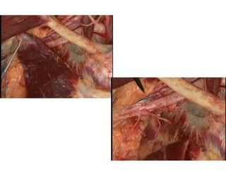 Pectoralis Major Myocutaneous Flap in Head and Neck Reconstruction | PPTX