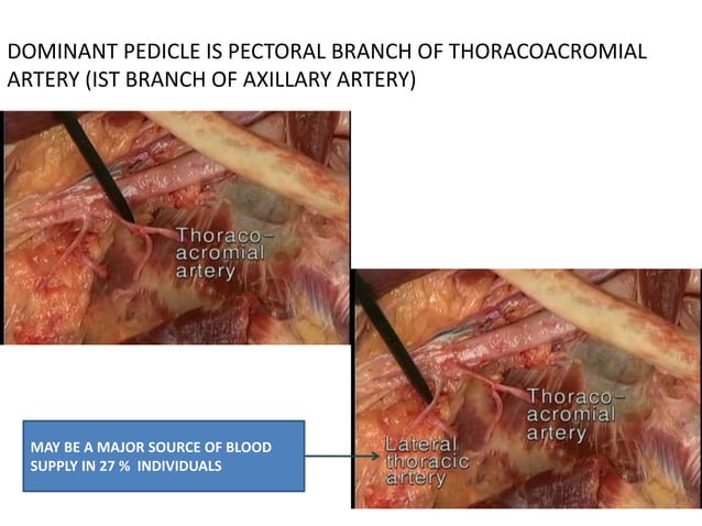 Pectoralis Major Myocutaneous Flap in Head and Neck Reconstruction | PPTX
