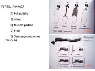Pectoralis Major Myocutaneous Flap in Head and Neck Reconstruction | PPTX