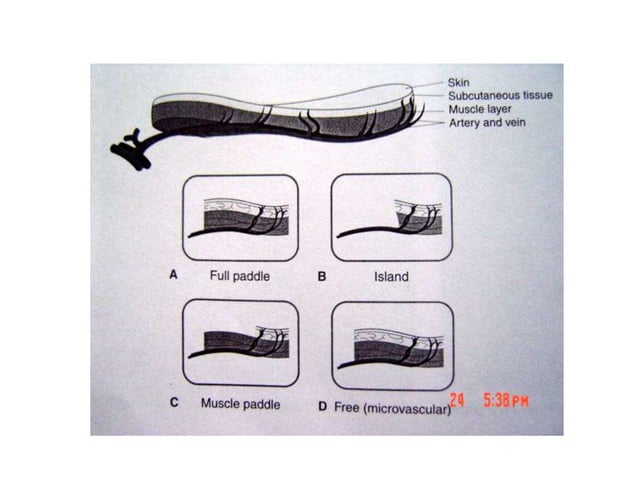 Pectoralis Major Myocutaneous Flap in Head and Neck Reconstruction | PPTX