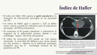 Pectus Excavatum | PPTX