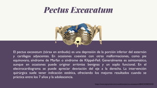 Pectus Excavatum | PPTX