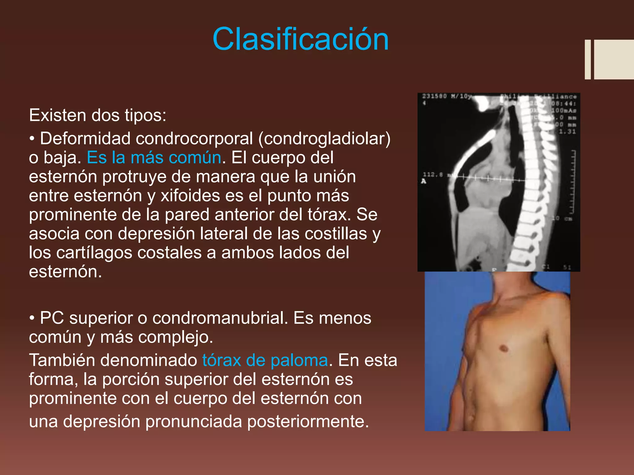 Pectus carinatum ppt | PPTX
