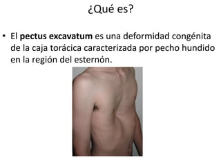 Pectus excavatum | PPTX