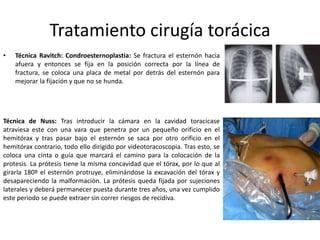 Pectus excavatum | PPTX