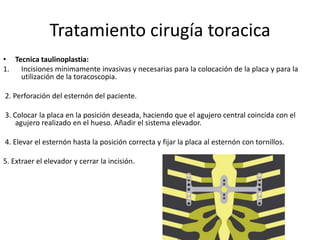 Pectus excavatum | PPTX