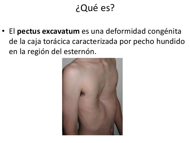 Pectus excavatum