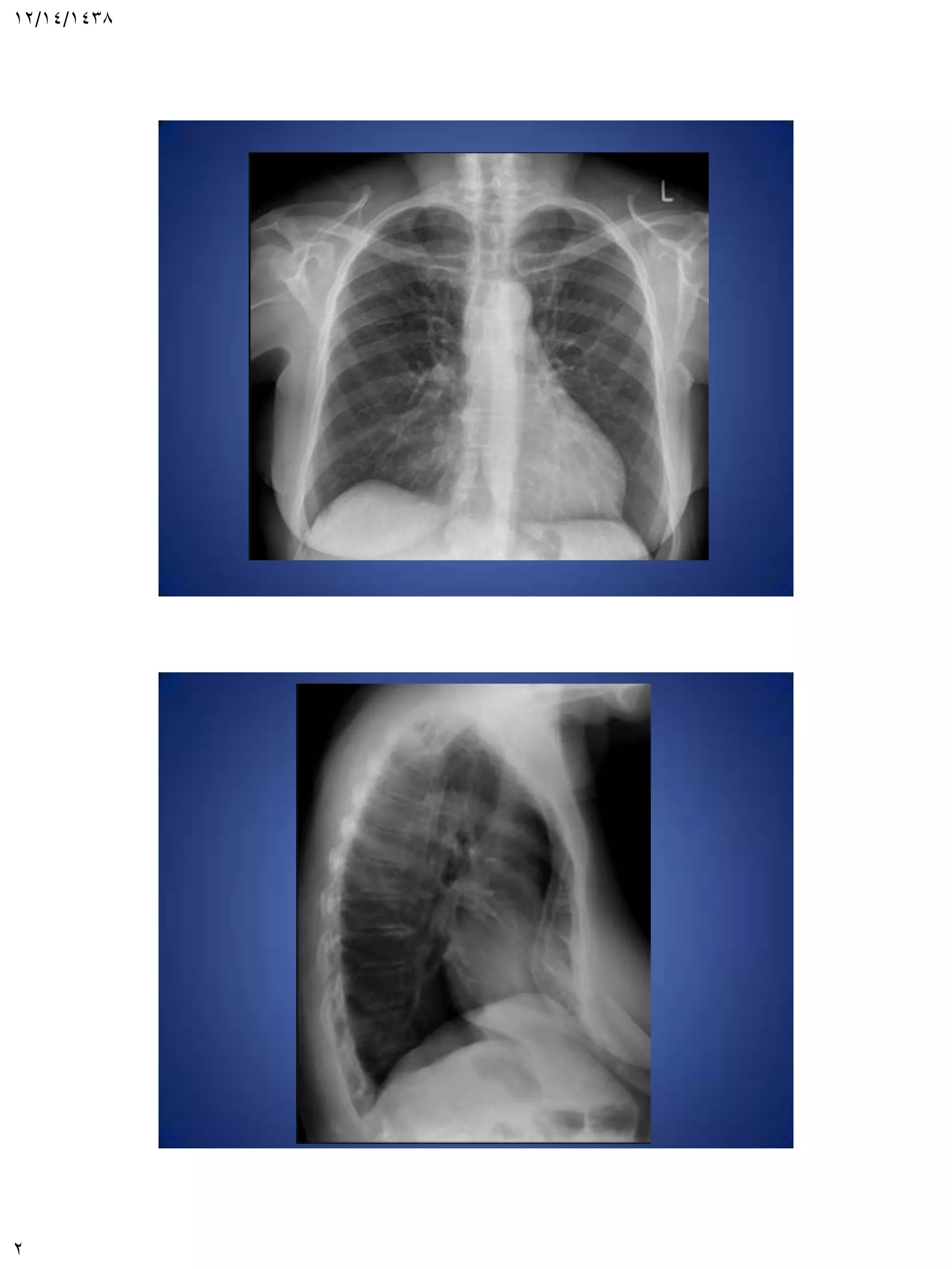 Pectus excavatum | PDF