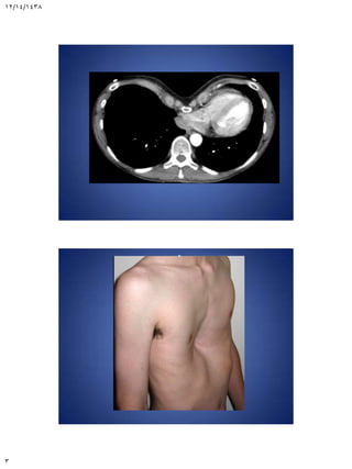 Pectus excavatum | PDF